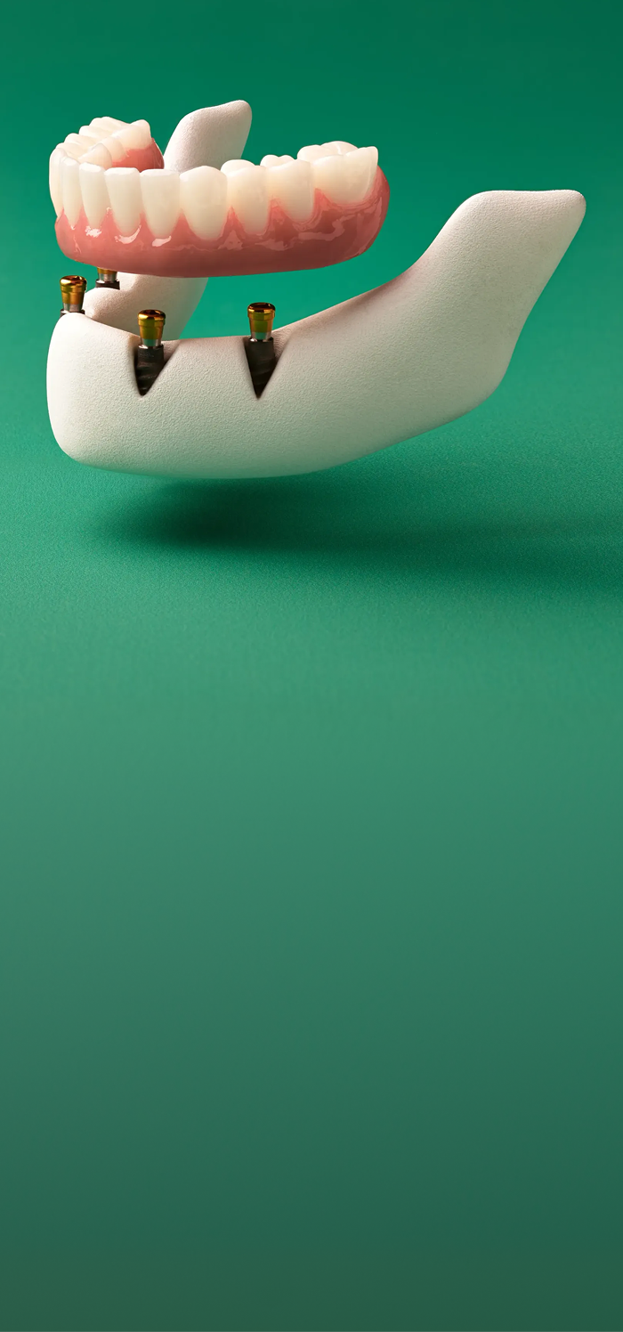 Full Mouth Dental Implants: Cost, Recovery & Benefits | Aspen Dental