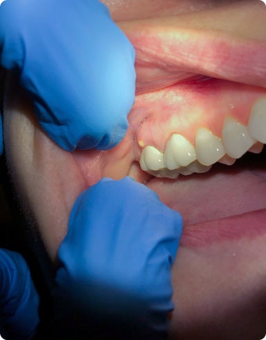 Dental abscess: Causes and treatment | Aspen Dental