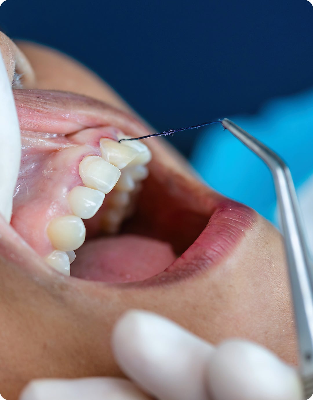 Periodontal surgery procedure | Aspen Dental