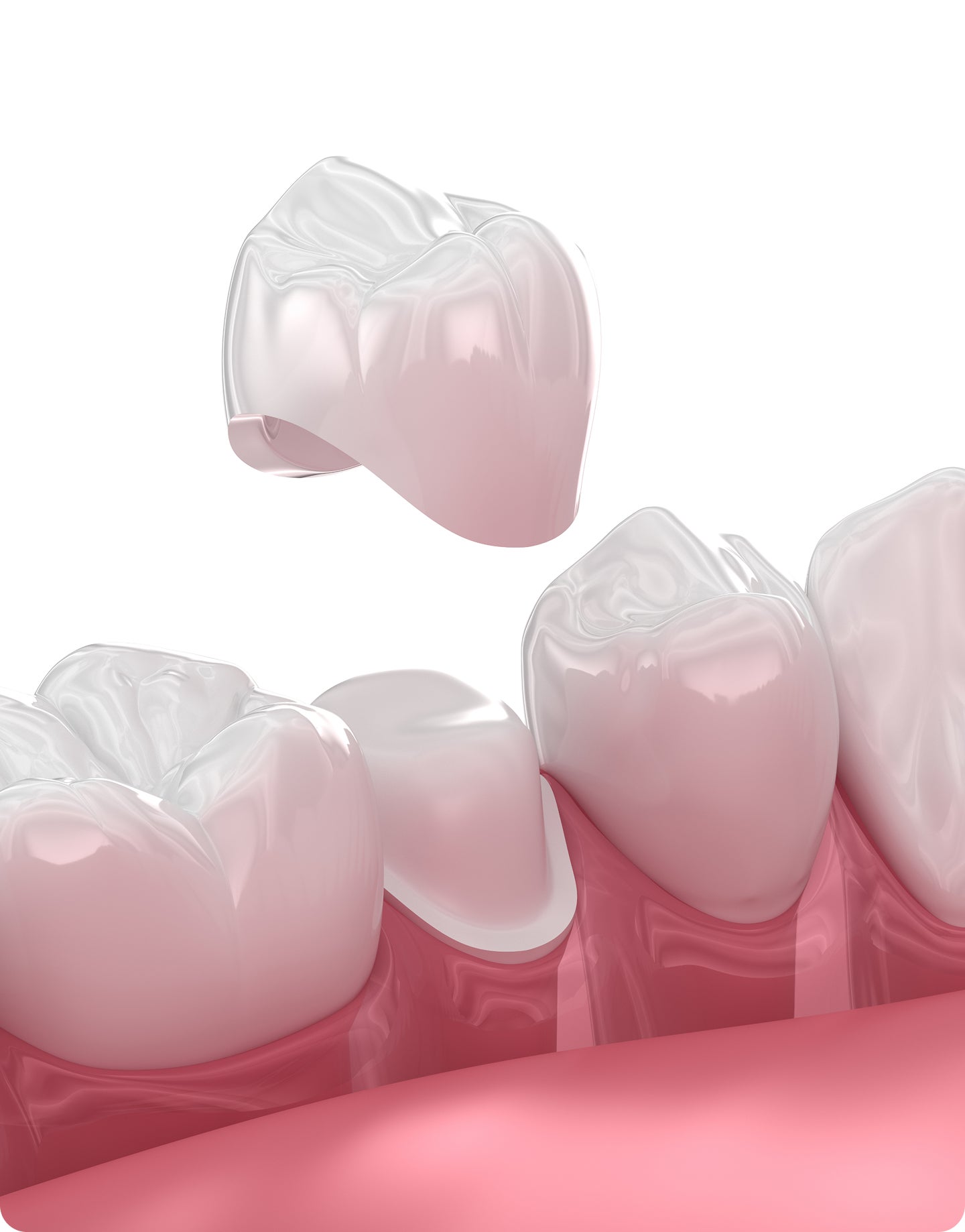 Tooth Cap: Types, Benefits, Cost and Expert Care | Aspen Dental