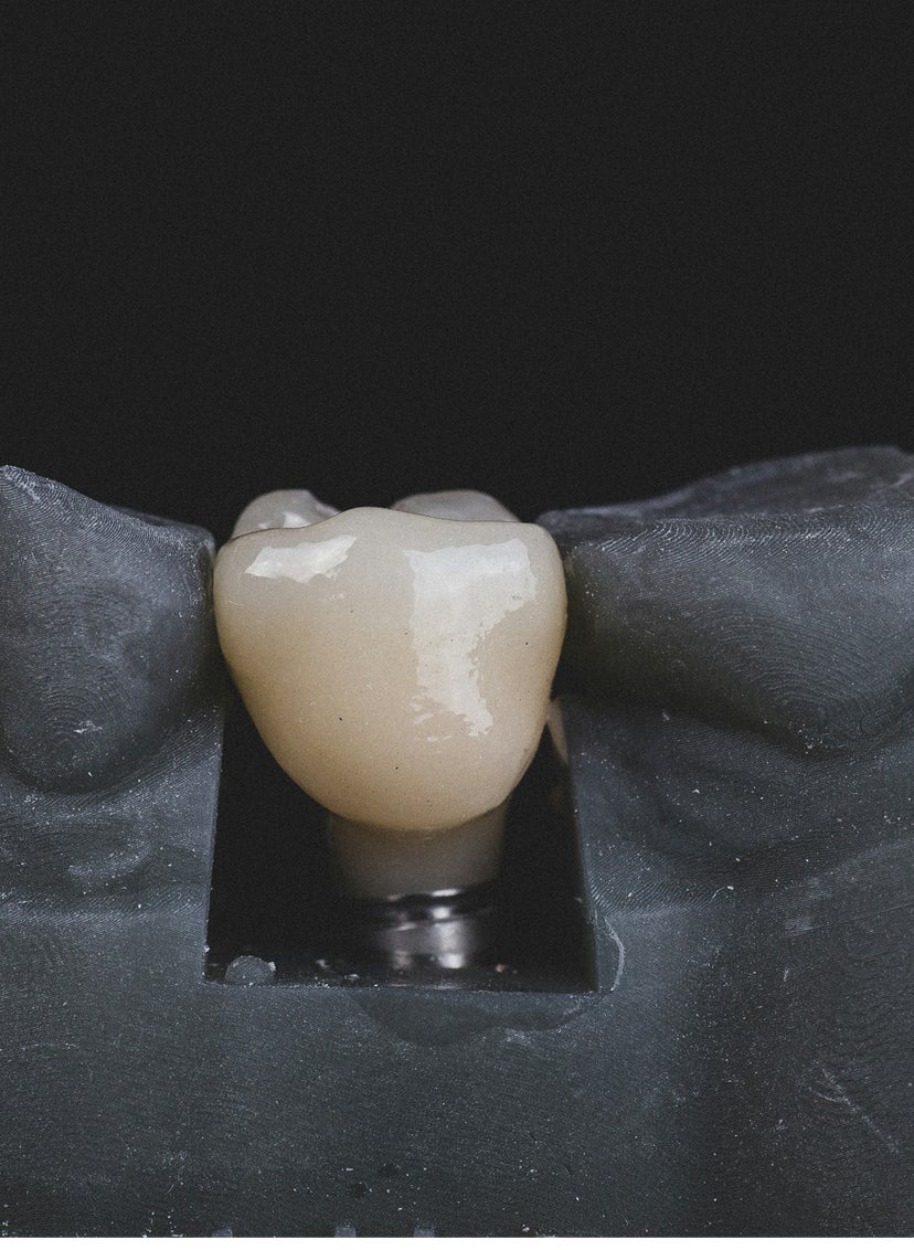 Dental implant crown fell out: what it means, immediate steps, and how ...