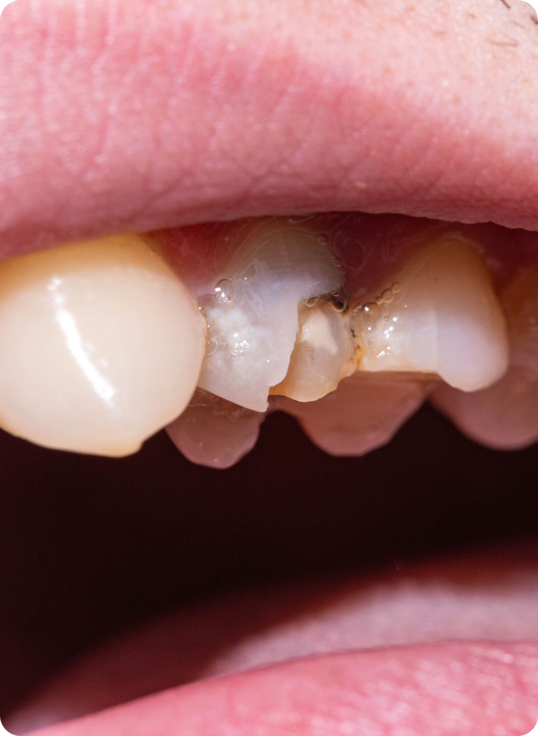 What to do if you have a chipped crown | Aspen Dental