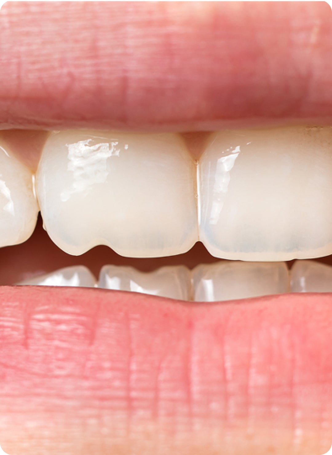 Black teeth: stains, causes, risks and treatment | Aspen Dental