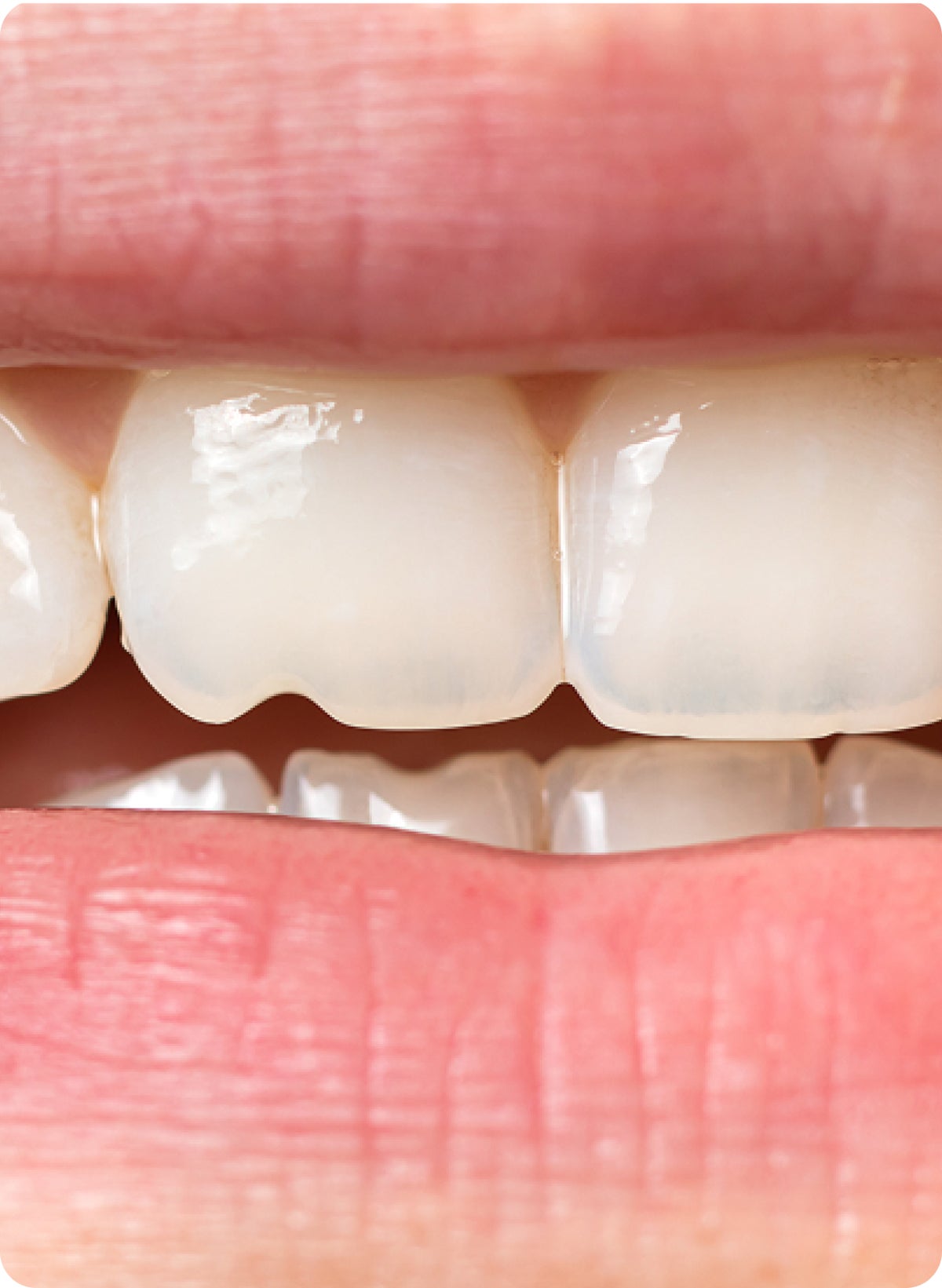 How long does fluoride varnish last? | Aspen Dental