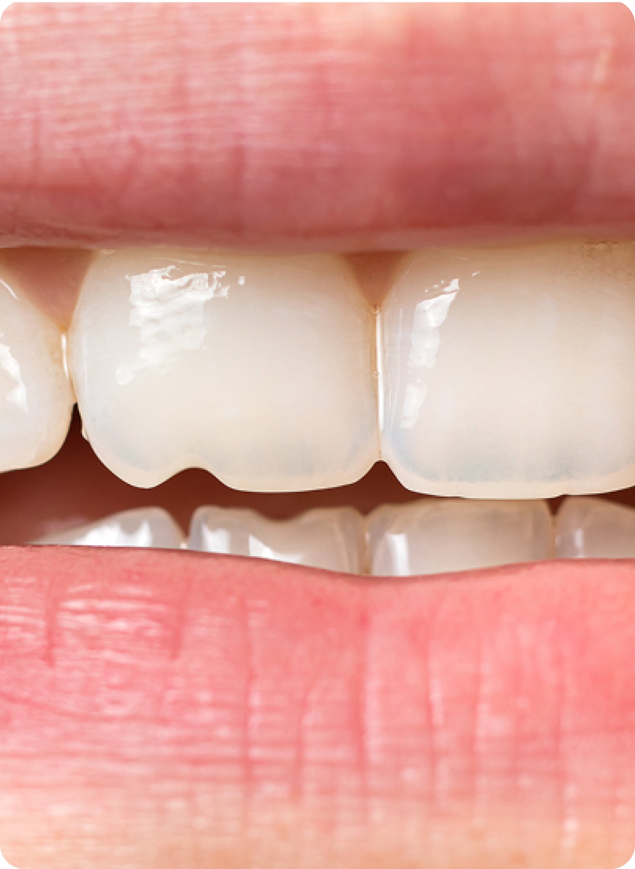 Cracked tooth: symptoms, causes and treatment options | Aspen Dental