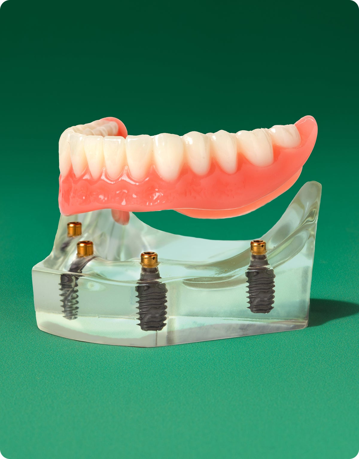 All on 4 Dental Implants: Full Arch Dental Implants | Aspen Dental