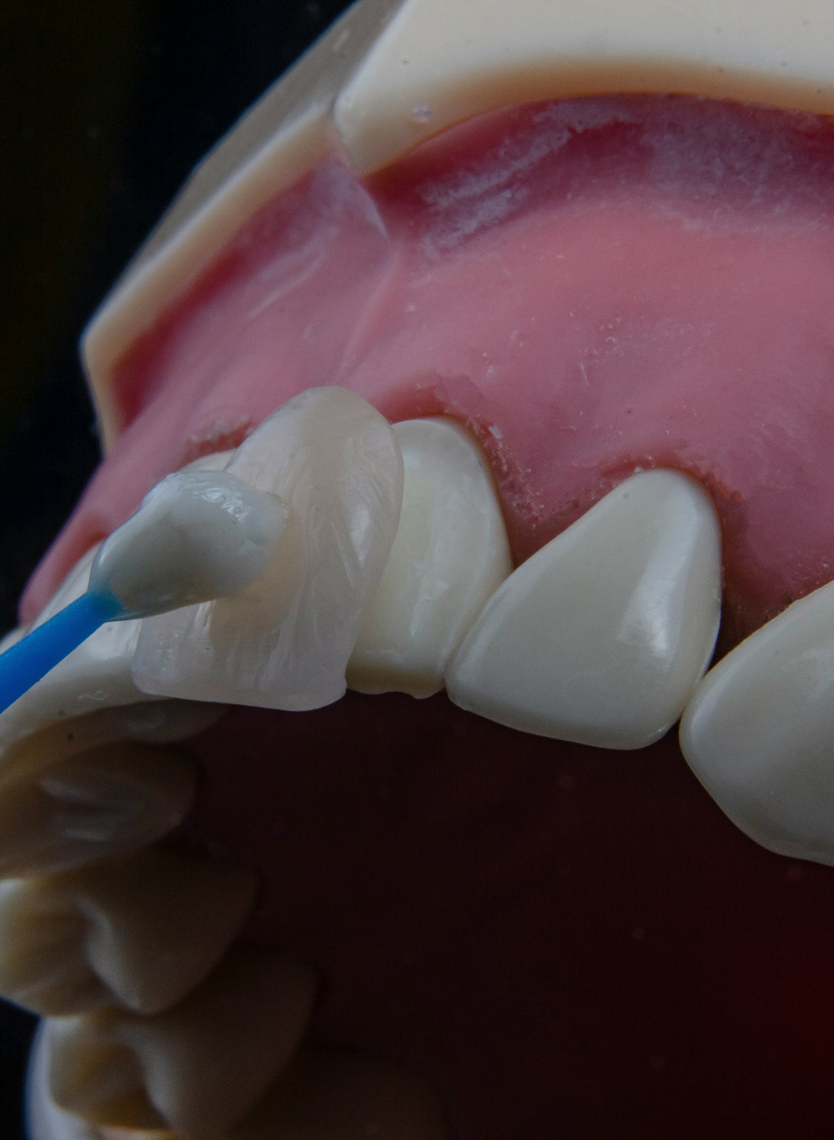 How missing teeth change face shape and lead to facial sagging ...