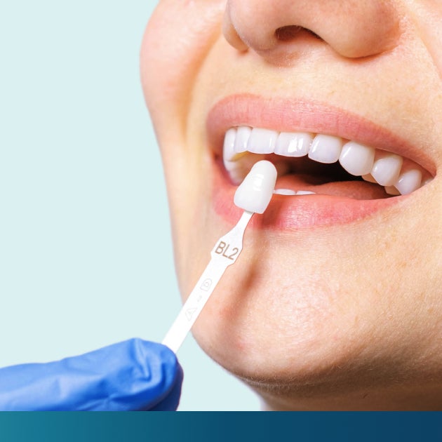 Buck Teeth: Causes, Symptoms and Treatments for an Overbite