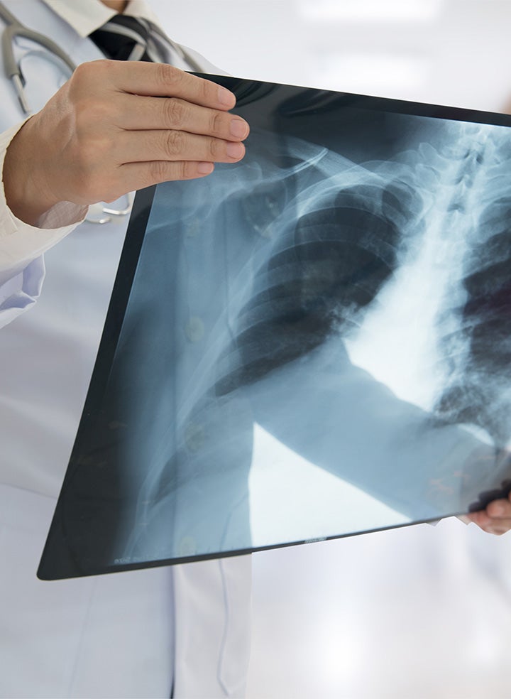 Understanding Walking Pneumonia | WellNow Urgent Care