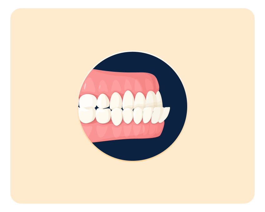 Buck Teeth: Causes, Symptoms and Treatments for an Overbite