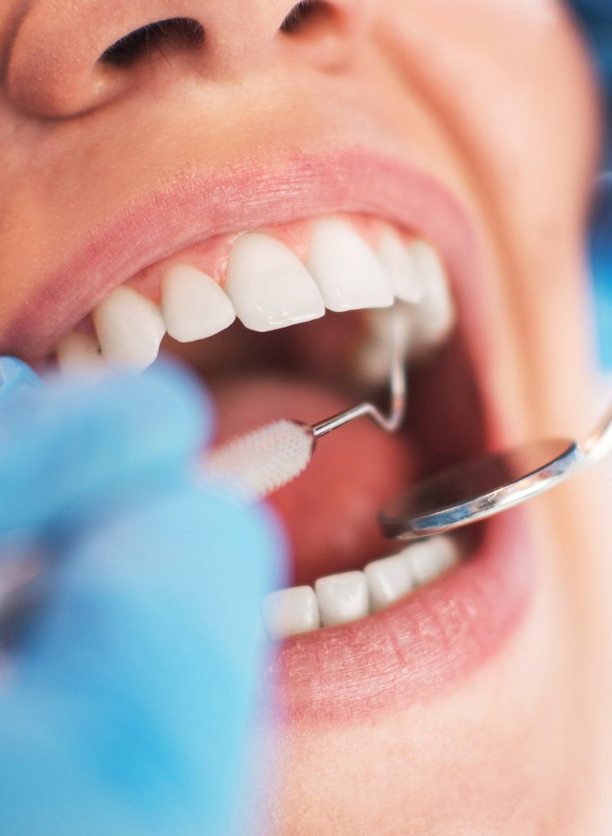 Dry socket: causes, symptoms, treatment and prevention | Aspen Dental