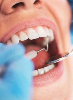 Dry socket: causes, symptoms, treatment and prevention | Aspen Dental