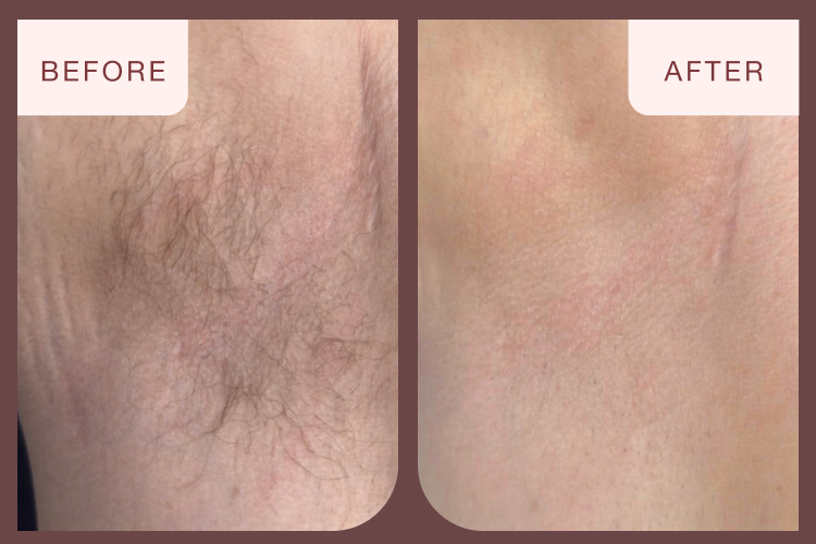 Laser hair removal in Fargo, ND | Chapter Aesthetic Studio