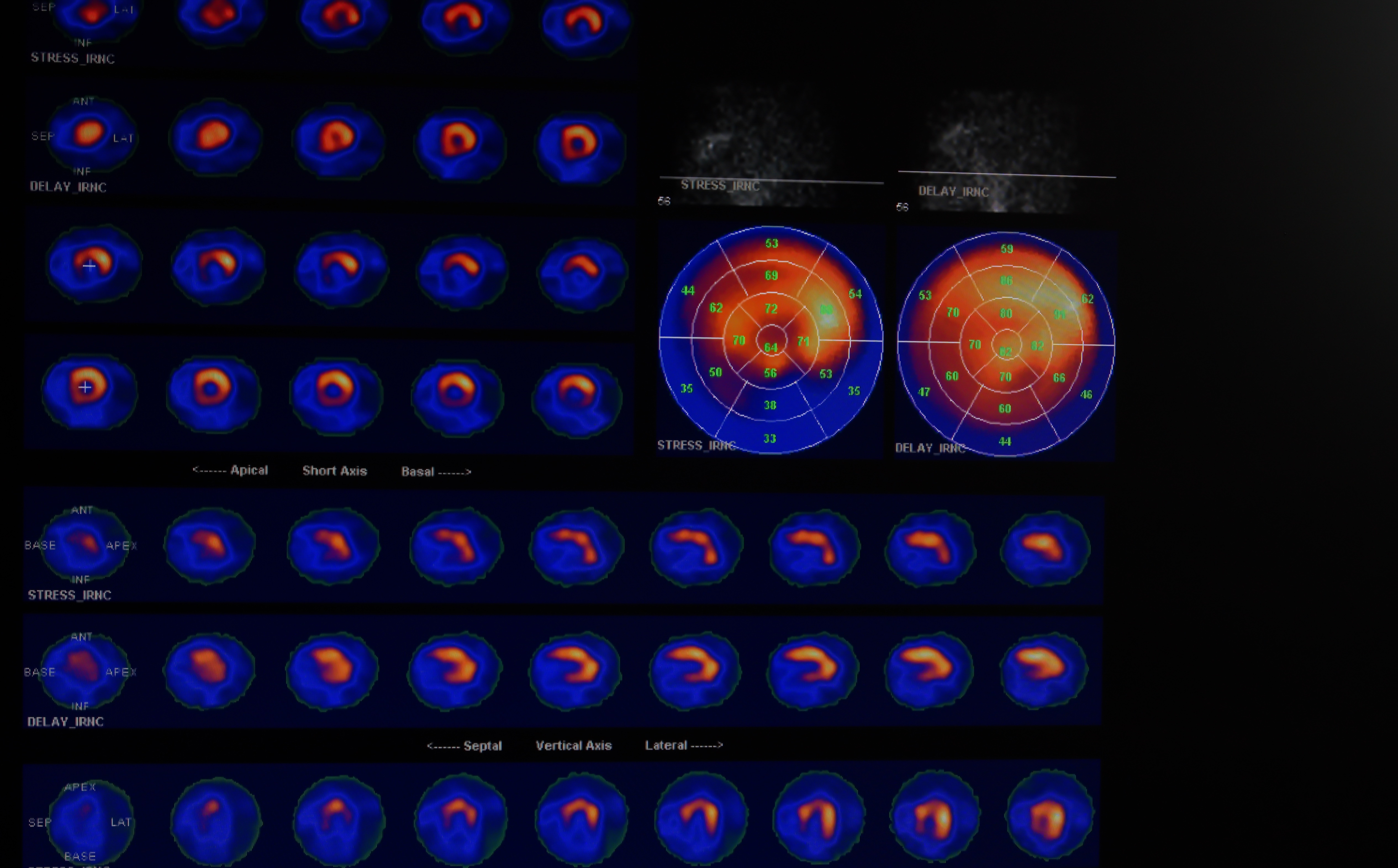 MUGA Scan